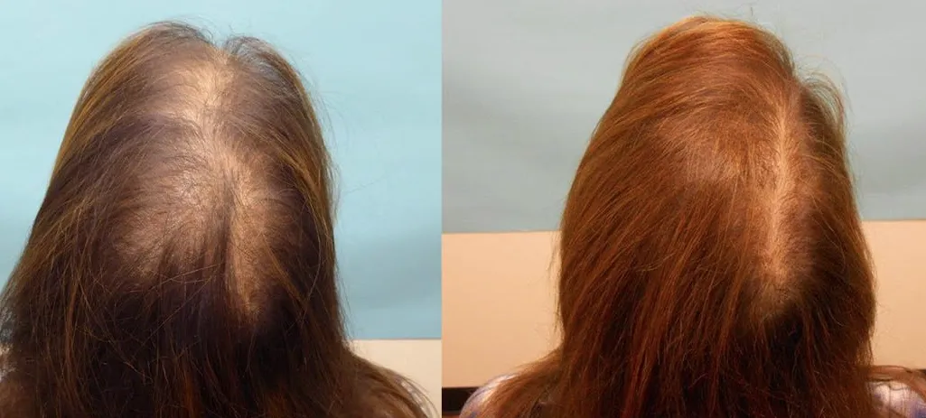 Do Laser Hair Growing Cap Really Work And What's The Best One ...