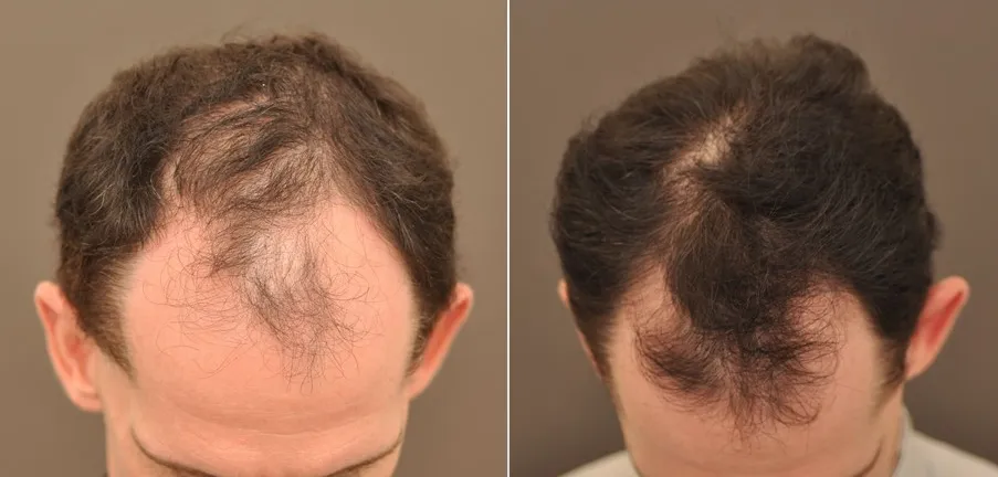 Do Laser Hair Growing Cap Really Work And What's The Best One ...