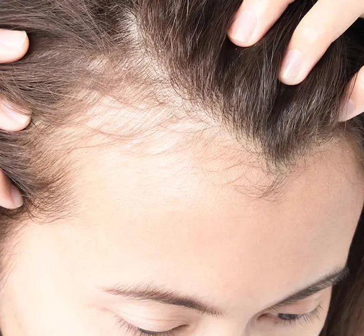 What Are Hair Patches For Bald Spots And Where To Buy? - Hair System