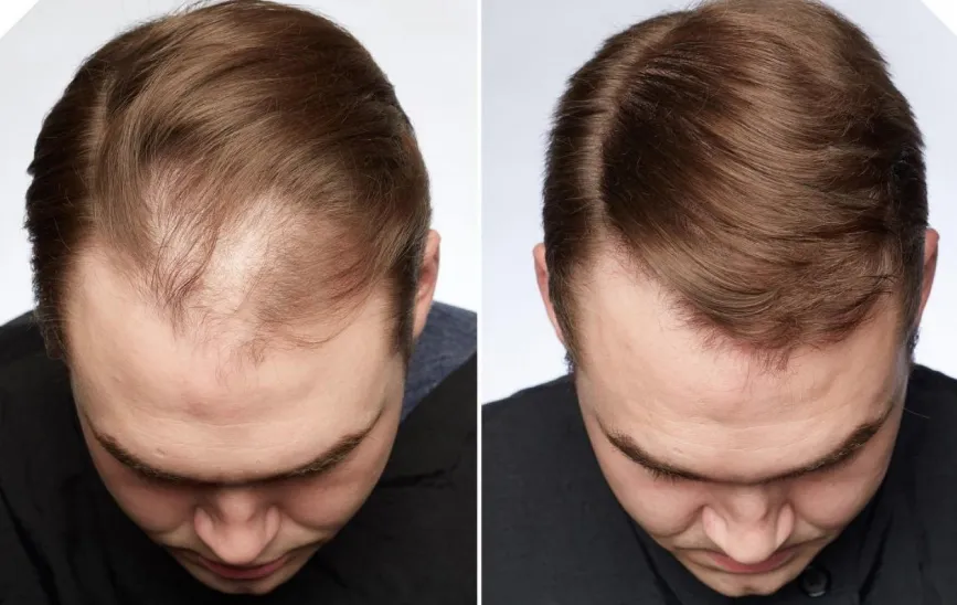 Revolutionizing Hair Health: The Igrow Helmet Explained - Toplasercap.com