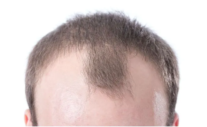 How to fix your bad hairline? - Hair System