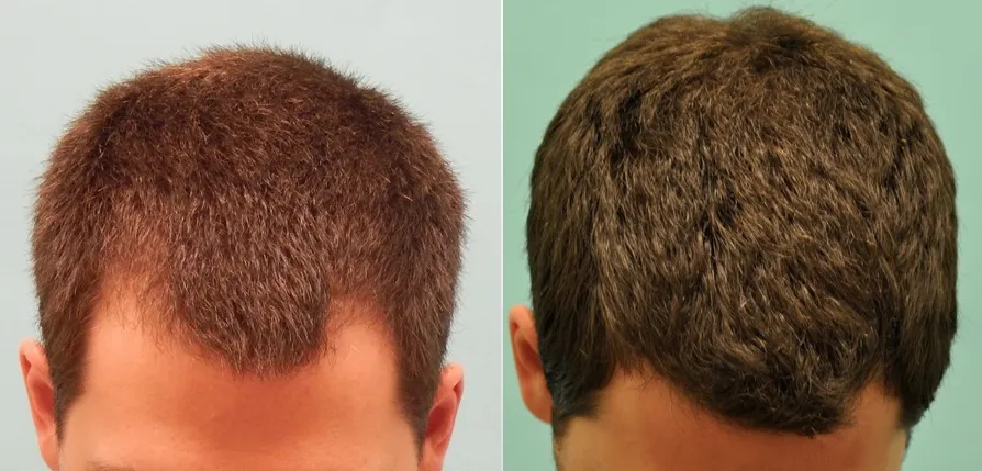 Do Laser Hair Growing Cap Really Work And What's The Best One ...