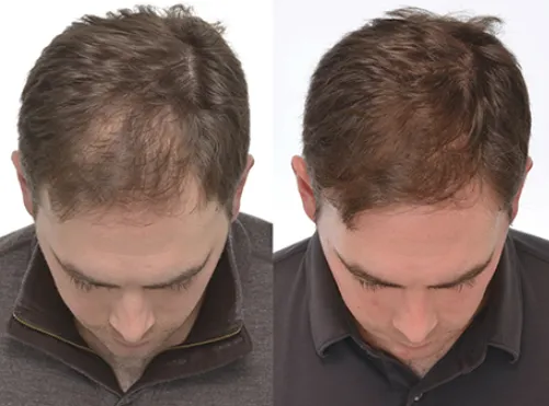 Revolutionizing Hair Health: The Igrow Helmet Explained - Toplasercap.com