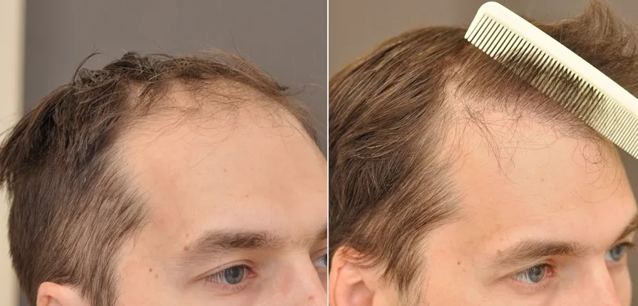 Do Laser Hair Growing Cap Really Work And What's The Best One ...
