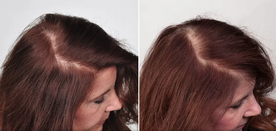 Revolutionizing Hair Health: The Igrow Helmet Explained - Toplasercap.com