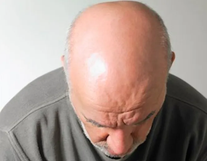 Shiny Bald Head: How To Get Rid Of It Or Make It More Shiny ...