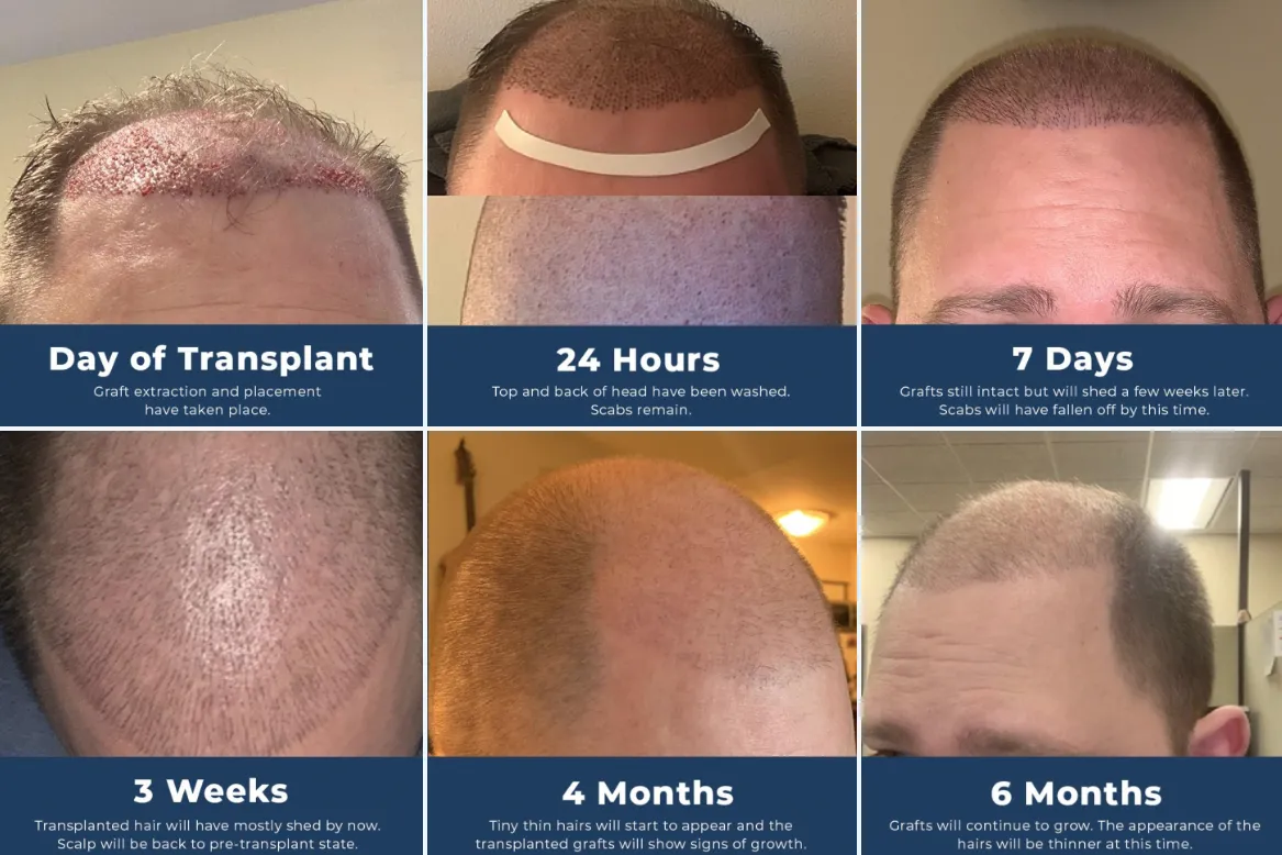 Which To Choose: LaserCap SD, LaserCap HD or LaserCap HD+ ...